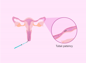 Tubal patency in Al Ain UAE - Al Ain Fertility Center